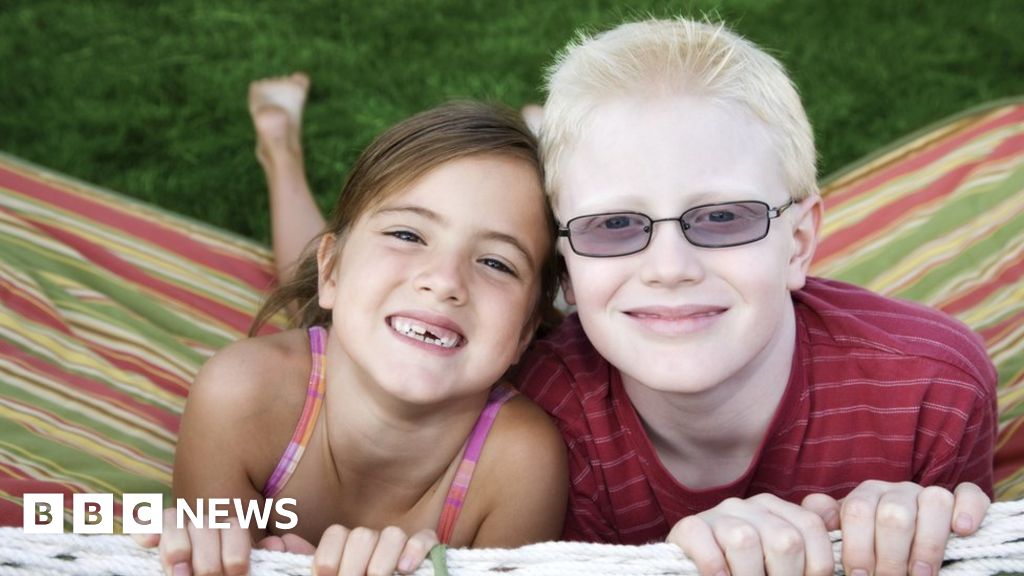 Call to end 'stigma' for people with albinism in Wales