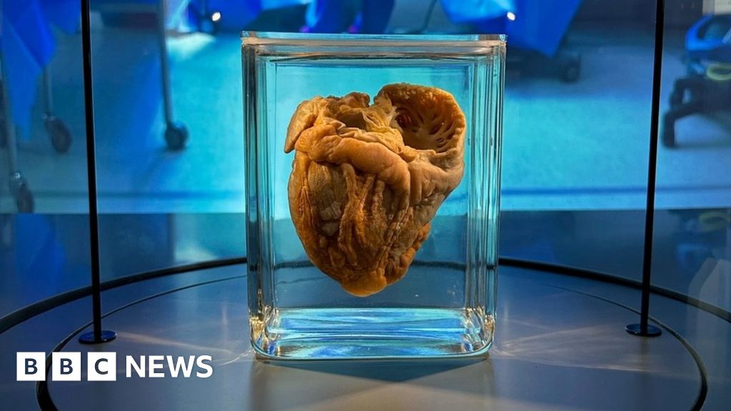 Transplant patient sees own heart go on display at museum