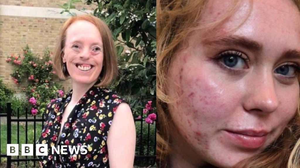 Campaign provides support for people with visible differences - BBC News