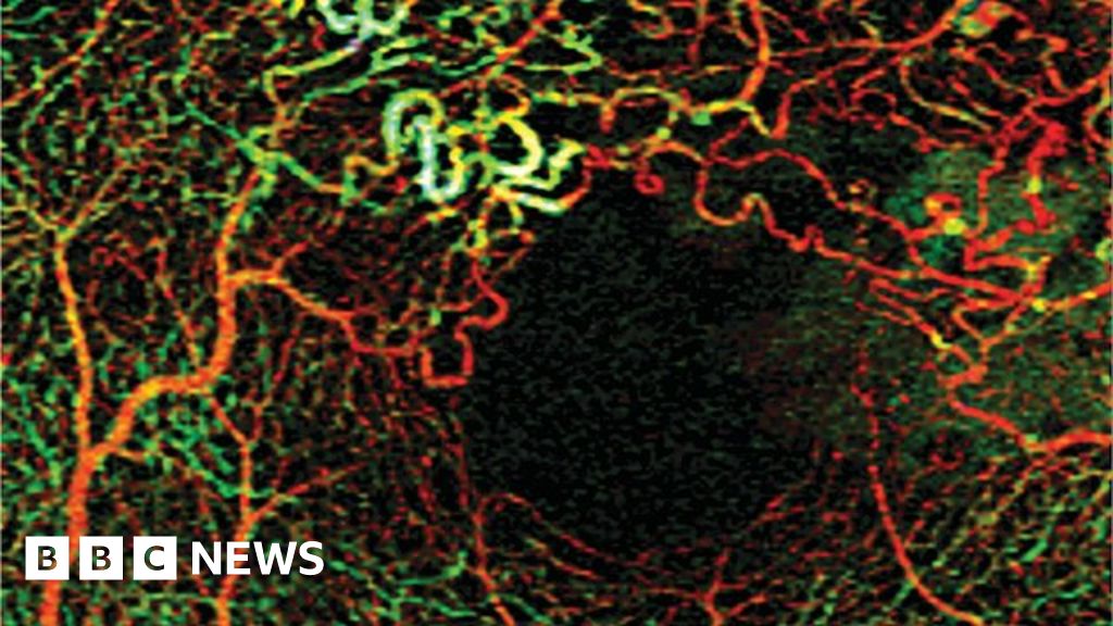 Plymouth scanner peers deep inside human eye - BBC News