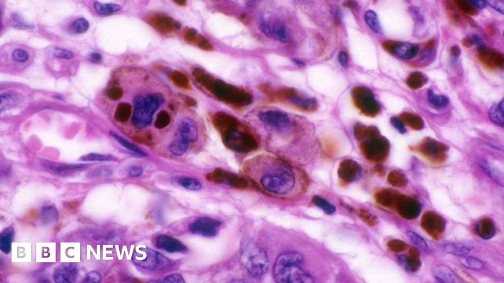 Melanoma skin cancer guidelines for NHS updated - BBC News