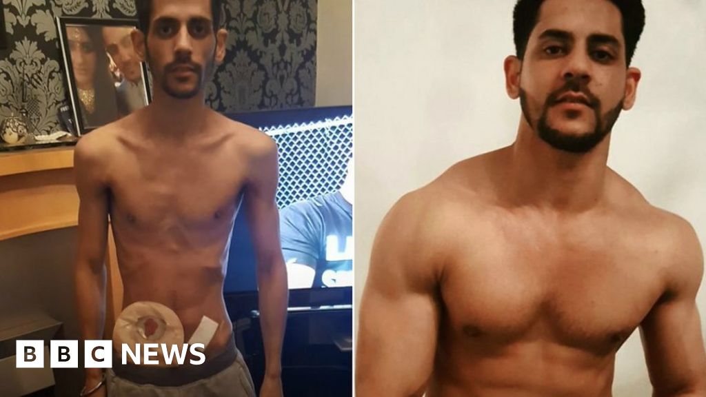 Crohn's disease: Weightlifter's remarkable transformation