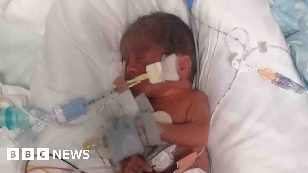 Baby born weighing 1lb 8oz celebrates first birthday - BBC News