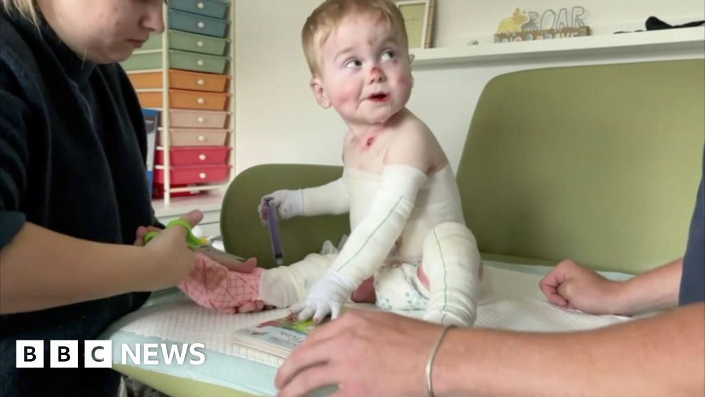 Epidermolysis bullosa: Toddler's fragile skin tears from cuddles