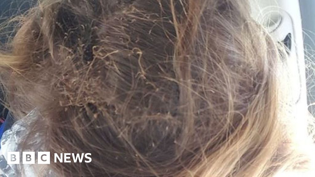 E-cigarette battery blast leaves mother with burnt scalp - BBC News