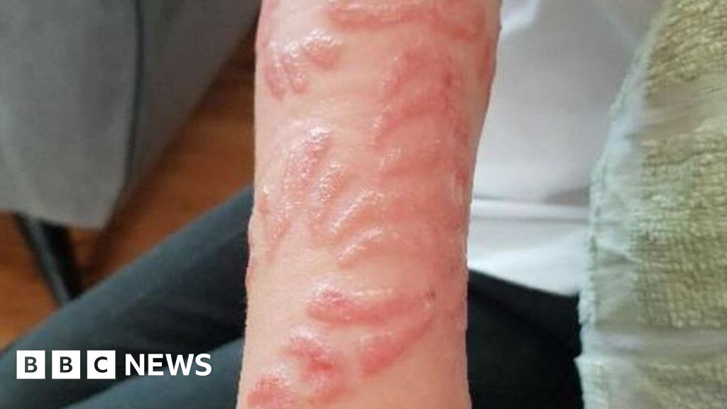 'Black henna' tattoos leave boys with chemical burns