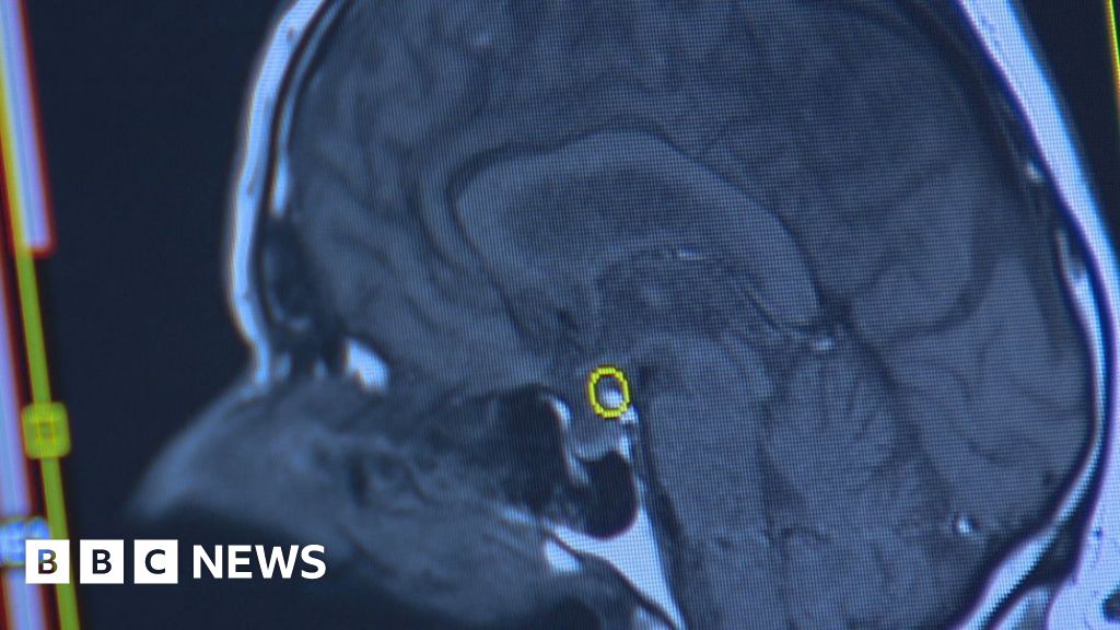 Scottish researchers find 100 genes linked to depression