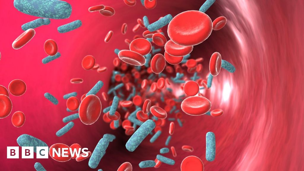 Sepsis: Why can it be so hard to spot? - BBC News