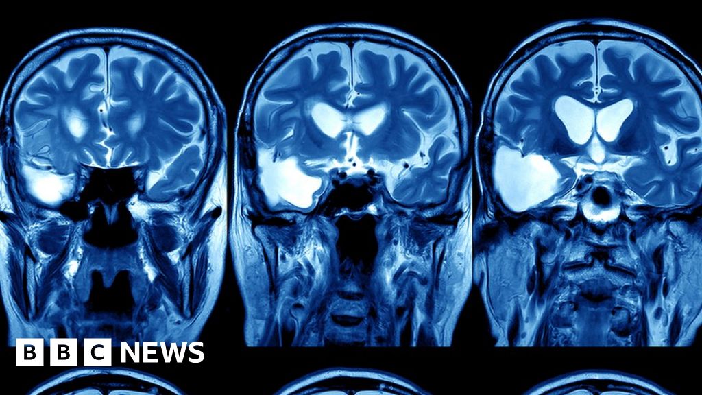 Google DeepMind targets NHS head and neck cancer treatment - BBC News