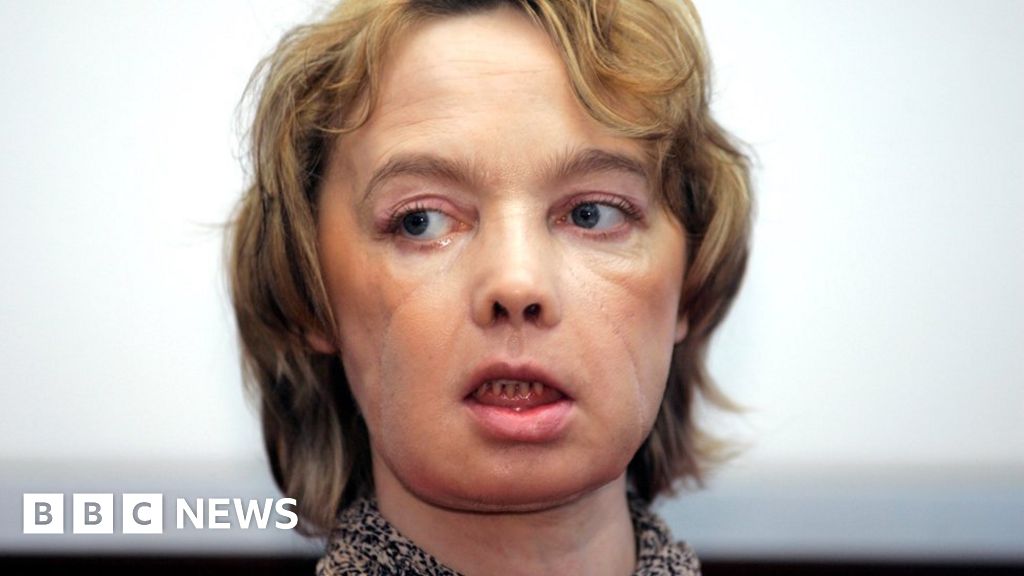 What's it like living with a face transplant? - BBC News