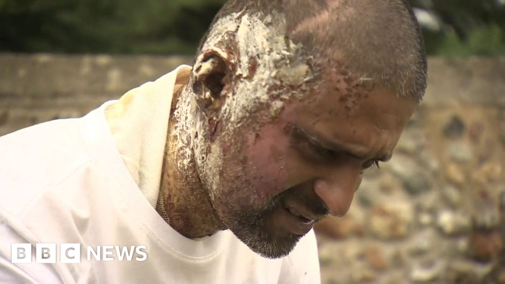 Acid attacks: NHS offers public advice on how to respond - BBC News