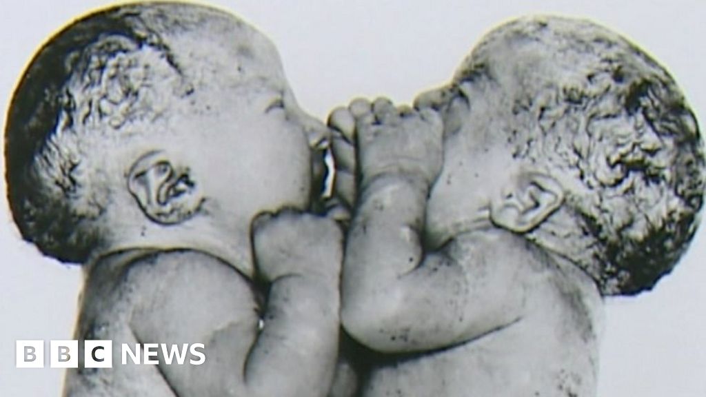 Conjoined twins' joy at watching news report of birth