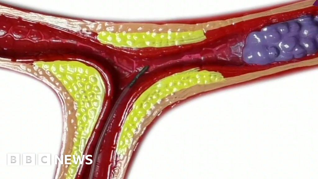 Magnetic spray could aid drug delivery and other news