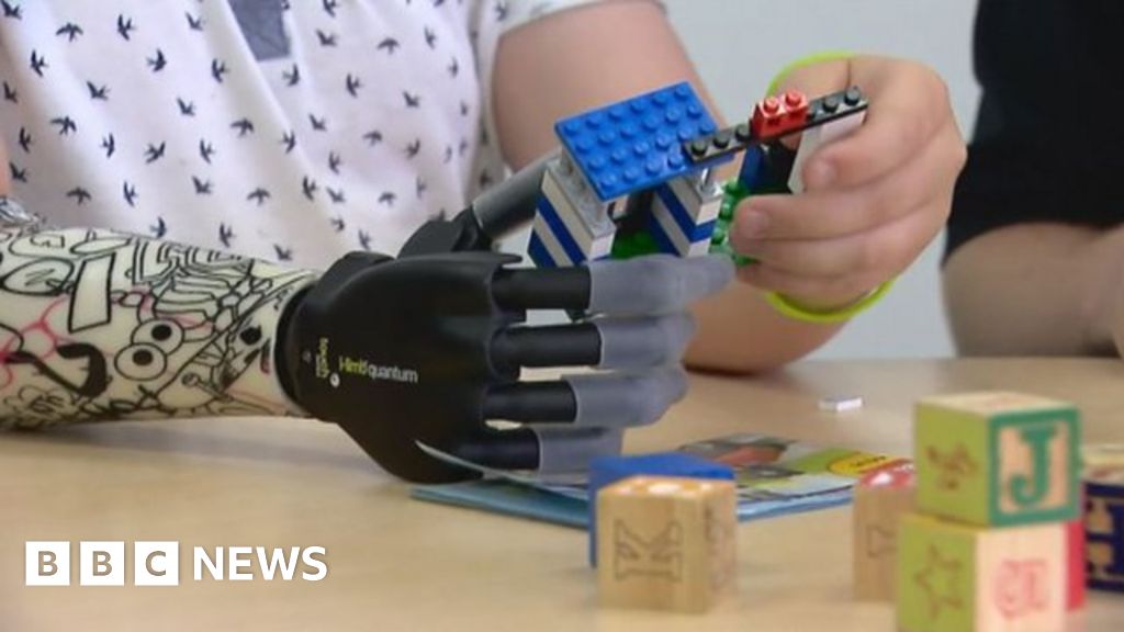 Fife boy is youngest person in world to wear bionic hand - BBC News