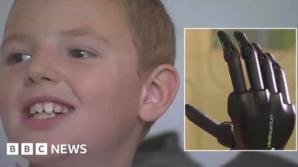 Swansea boy, 10, first to get new bionic hand in Wales - BBC News