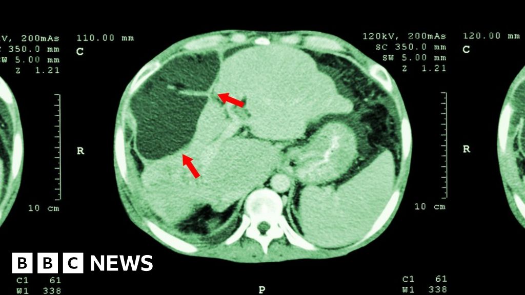 Liver cancer death rate rises by 52% - BBC News