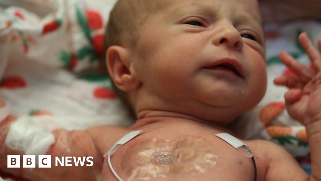 The patch unplugging premature babies - BBC News