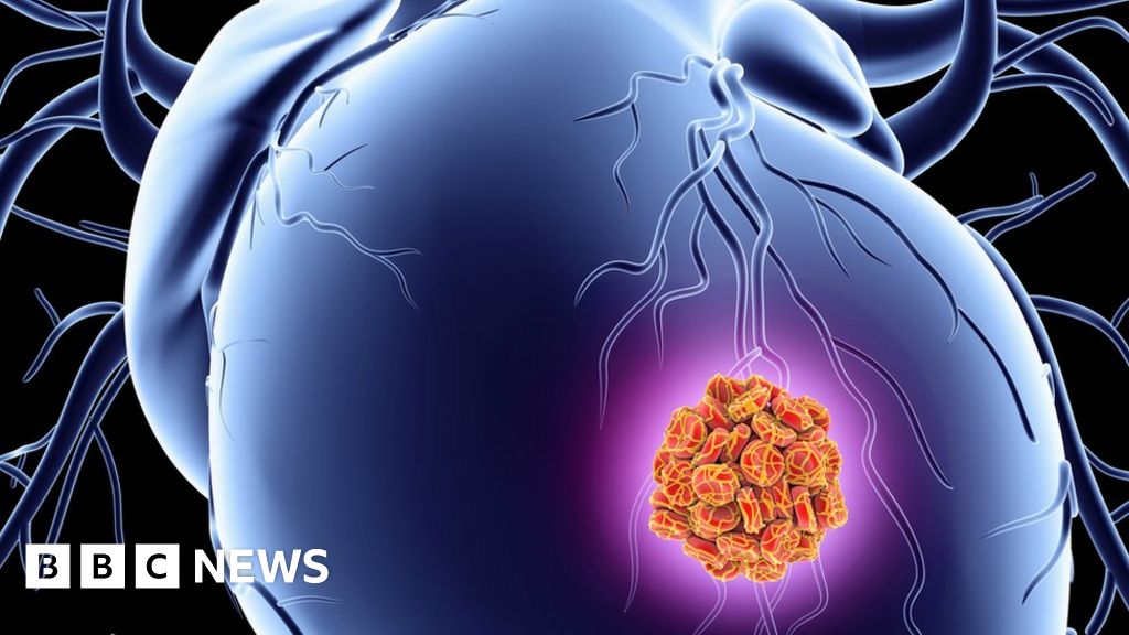Patch may boost repair after heart attack - BBC News