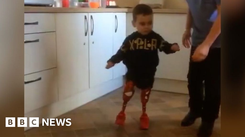 Child amputee Taylor Lewsley walks unaided for first time