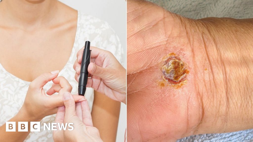 Bangor University developing gel for chronic diabetic wounds - BBC News