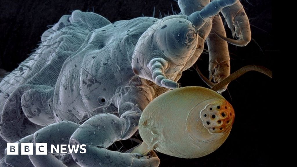 Lice infestation at police custody suite