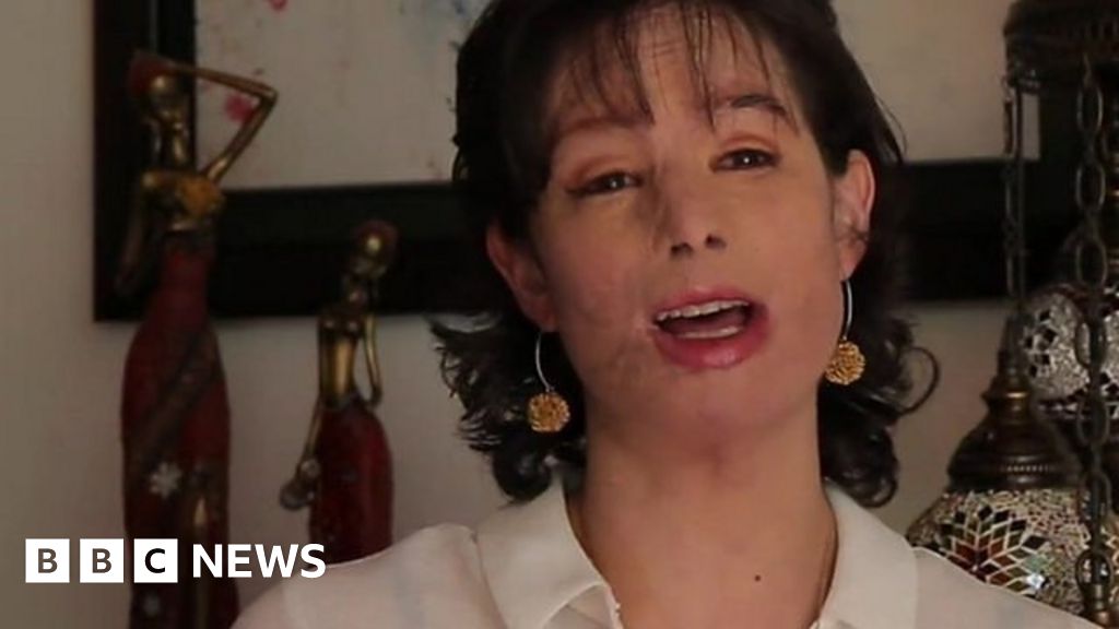 Acid attack victim: 'It has been a miracle that I am so well' - BBC News