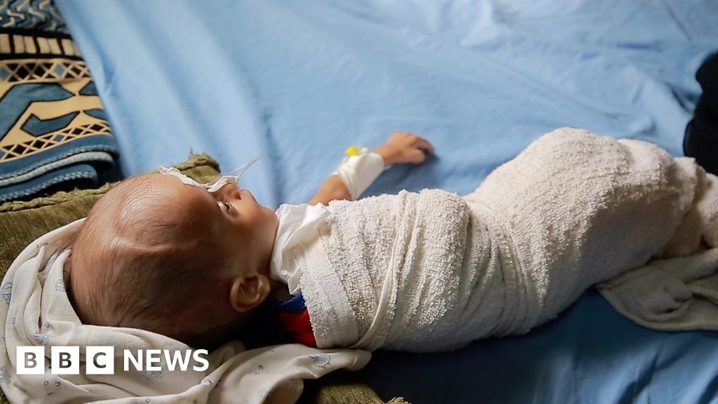 How children are starving in Yemen's war - BBC News
