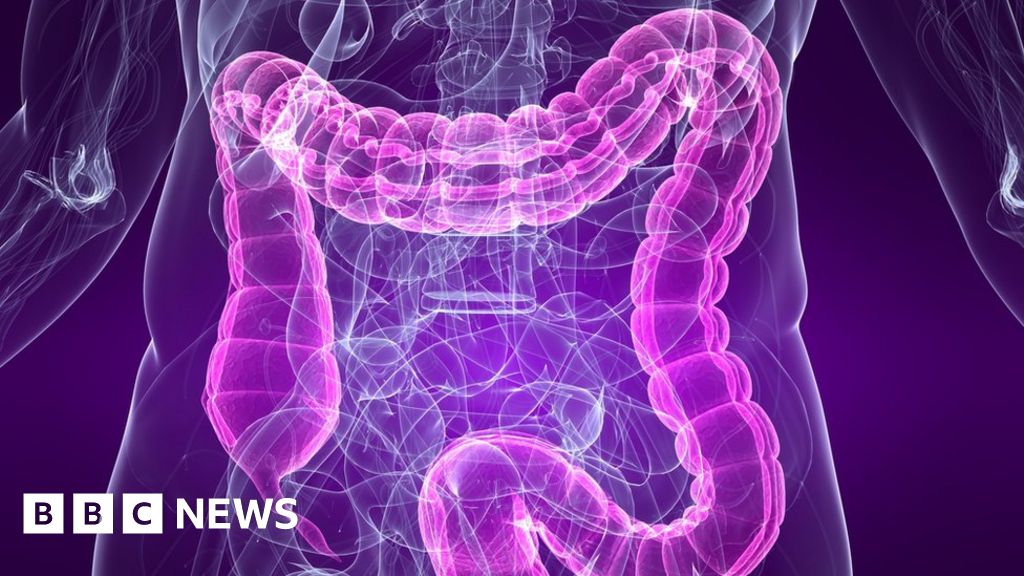 Colon cancers 'more deadly on right' - BBC News