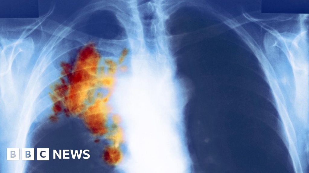 Rapid lung cancer diagnosis offered to South Manchester patients - BBC News
