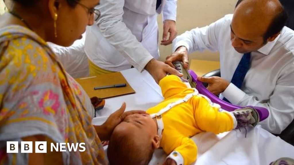 India: New ways of treating children with deformed foot - BBC News