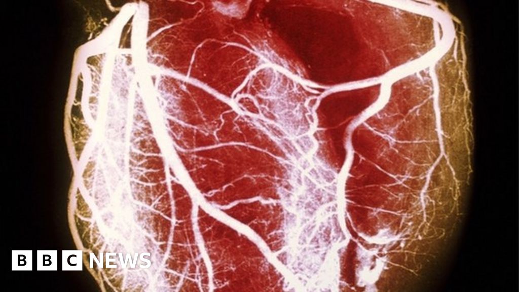 12 die from heart attacks each week, BHF Cymru says - BBC News