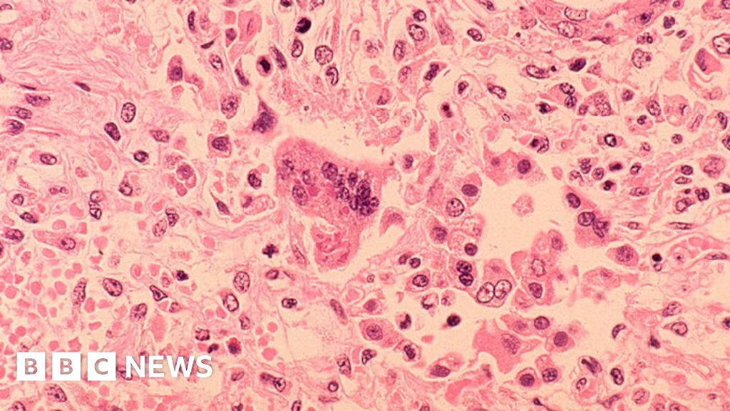 Measles: First death in 12 years reported in Washington state - BBC News