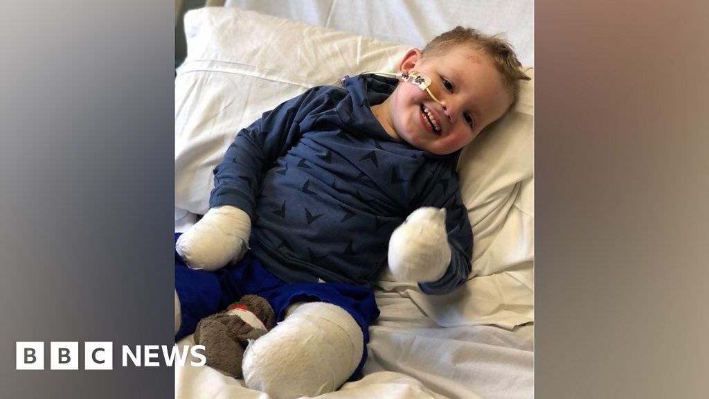 Sepsis: Boy learns to walk again after losing legs