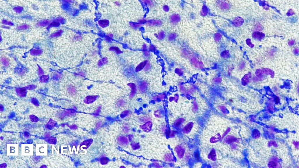 Living with MS: 'People don't realise the suffering' - BBC News