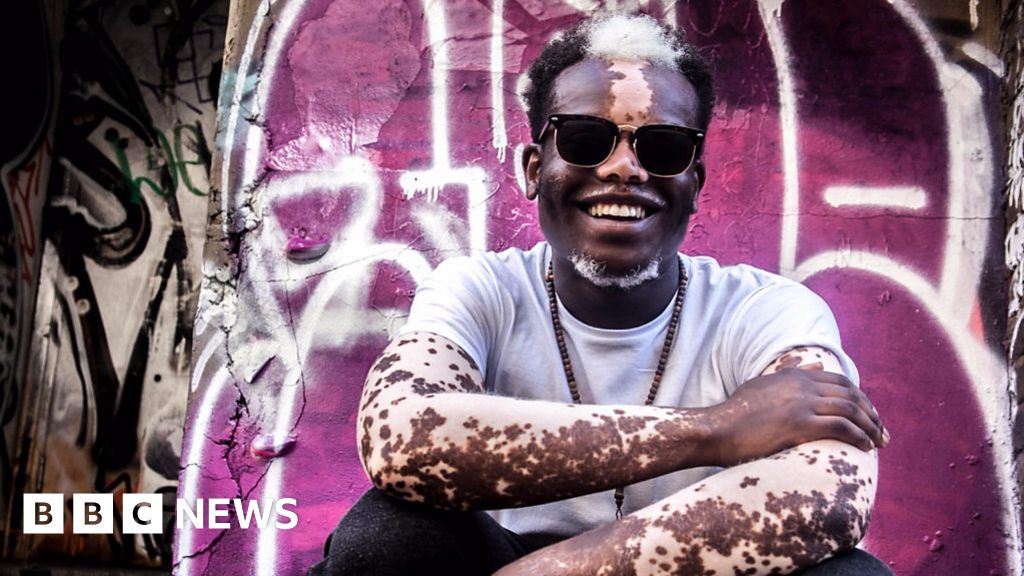 Vitiligo model told he 'looked like a zebra' - BBC News