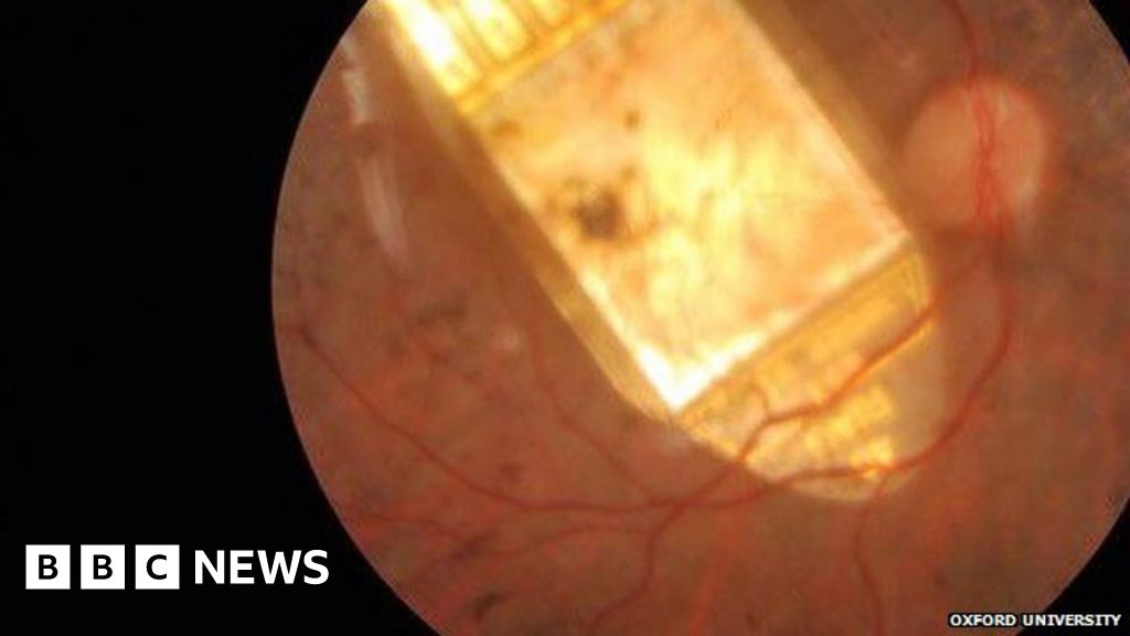 Bionic eye changing woman's life after losing sight - BBC News