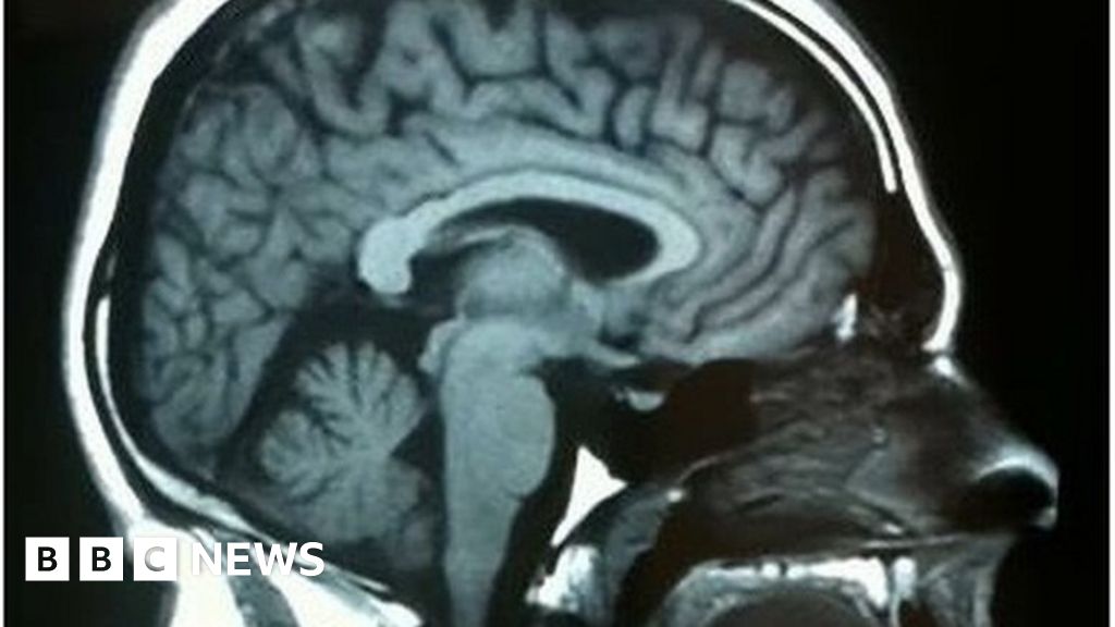 Alcohol-related brain damage at 10-year high - BBC News