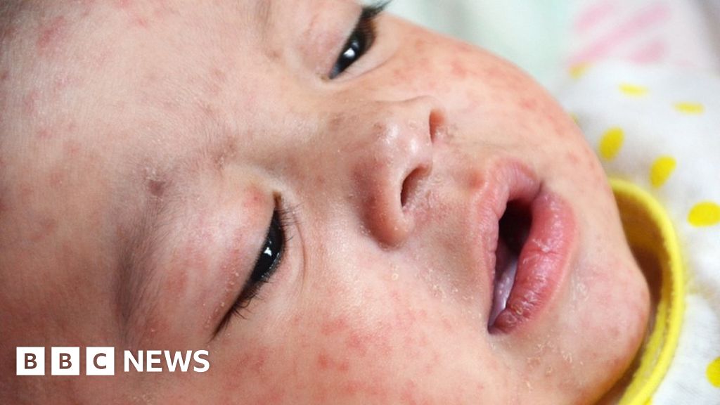 Nottingham measles cases linked to QMC's emergency department