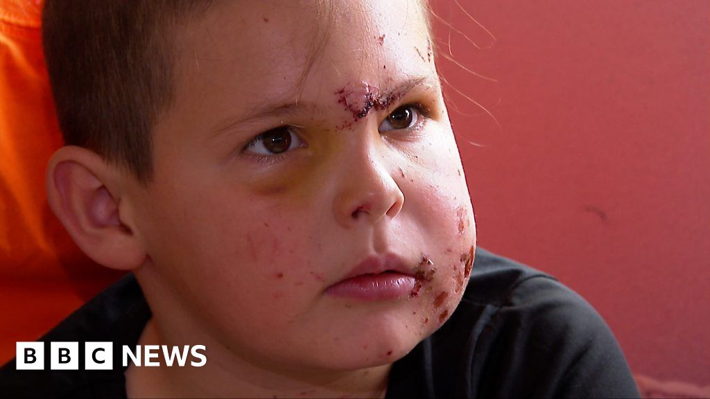 Fireworks: Boy, eight, almost loses sight in explosion - BBC News