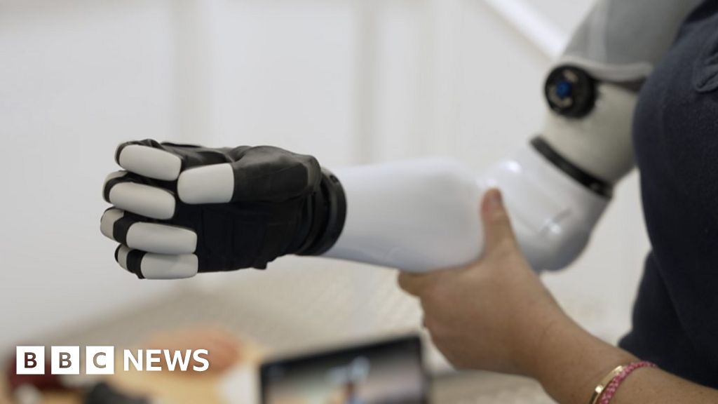 Woman's AI bionic arm is fitted after Tube near-death experience