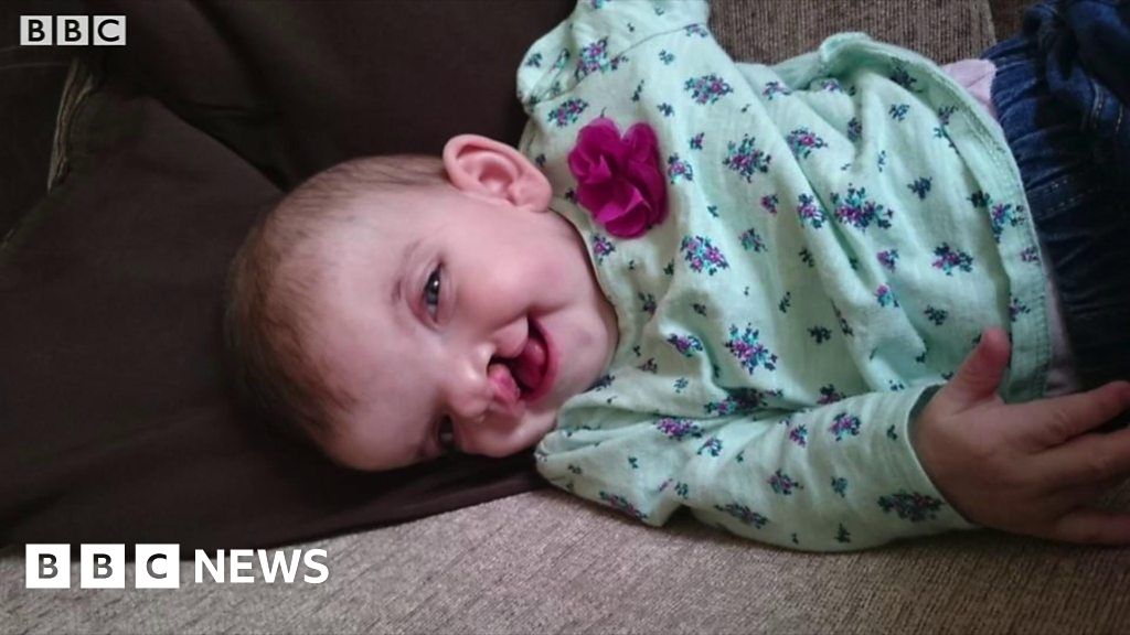 The surgeon who rebuilds children's skulls - BBC News