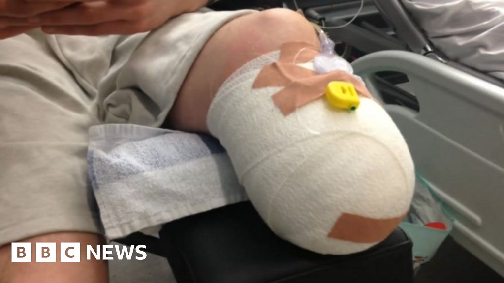 Leg loss patients left in limbo - BBC News
