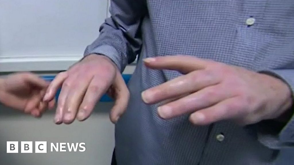 NHS at 70: Double hand transplant man returns to Leeds hospital