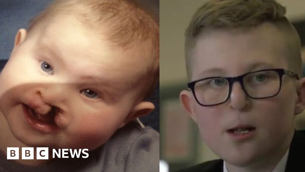 Sheffield student with cleft lip bullied for the way he looked - BBC News