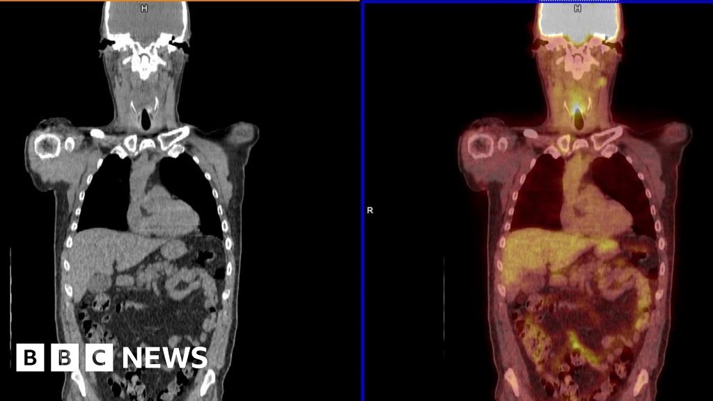 Cancer scans 'reduce risky operations' - BBC News