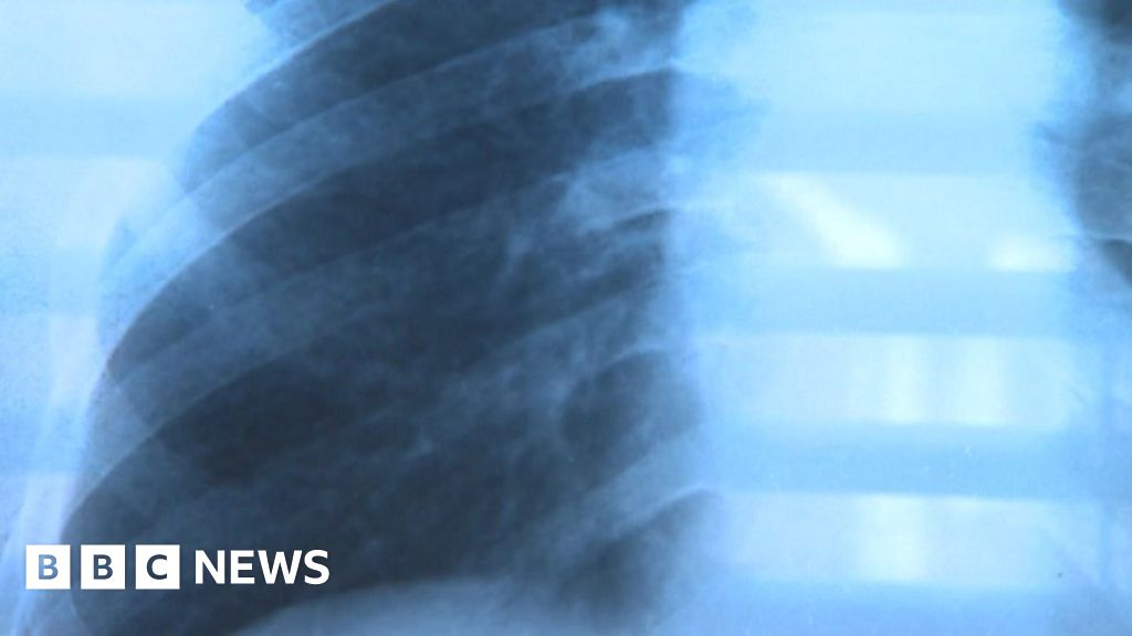 Miners' lung disease: 'Thousands may have pneumoconiosis' - BBC News
