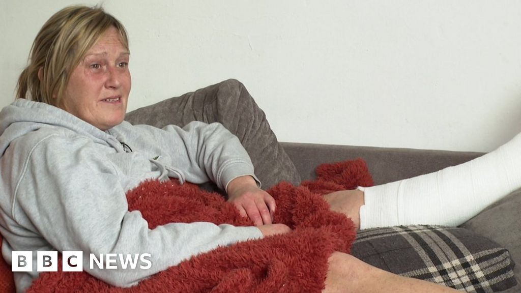 York woman does not blame XL bully after leg savaged