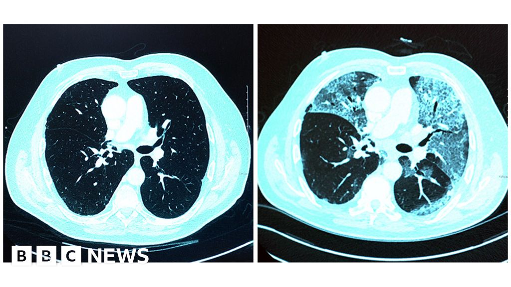 Coronavirus Warning Thousands Could Be Left With Lung Damage BBC News Coronavirus Warning Thousands Could Be Left With Lung Damage BBC News