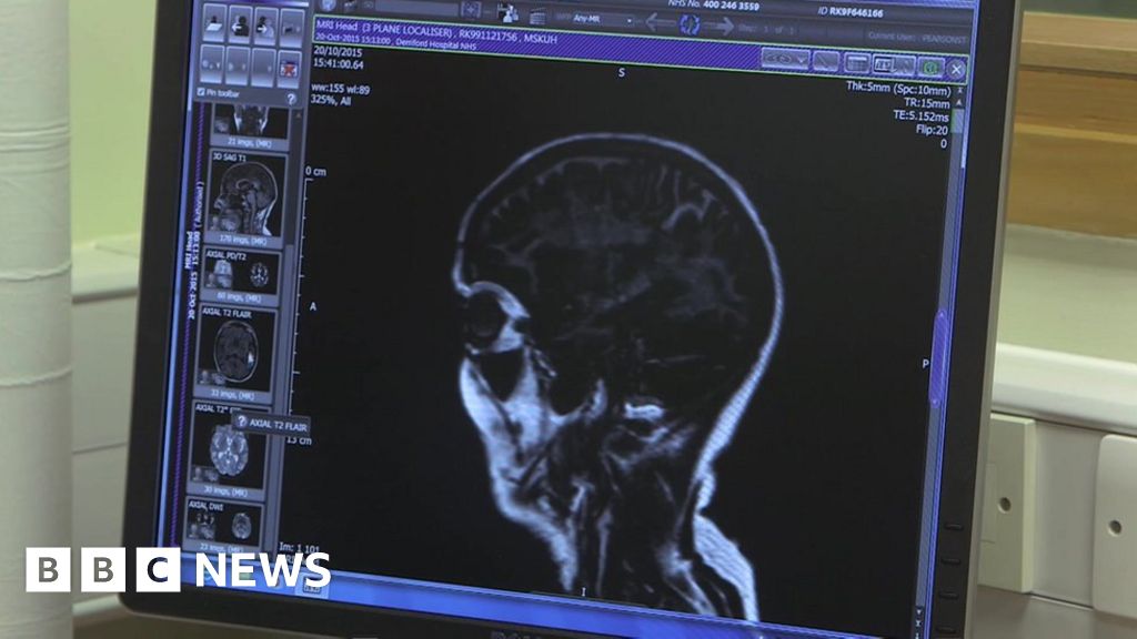 'Slow down' dementia drug trialled on patients - BBC News