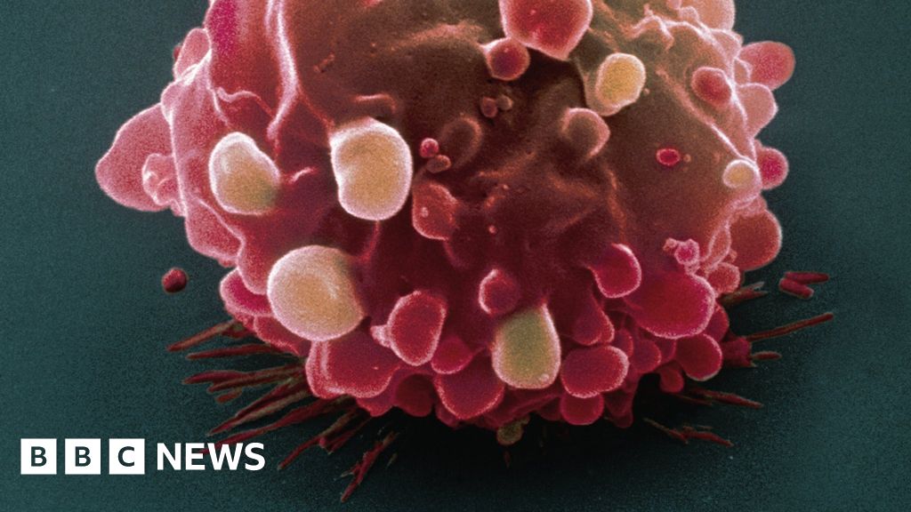 'More than half' ignored bowel cancer screening chance - BBC News